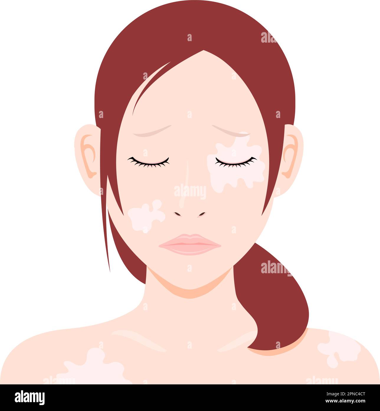 Symptoms of Vitiligo vector illustration Stock Vector Image & Art - Alamy
