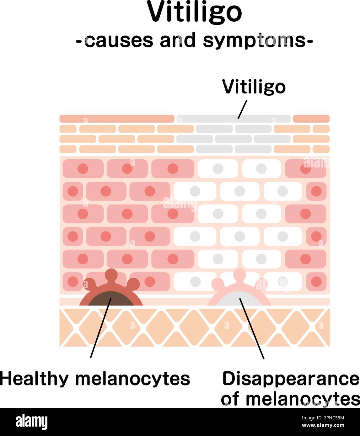 Causes And Symptoms Of Vitiligo Vector Illustration Stock Vector Image And Art Alamy