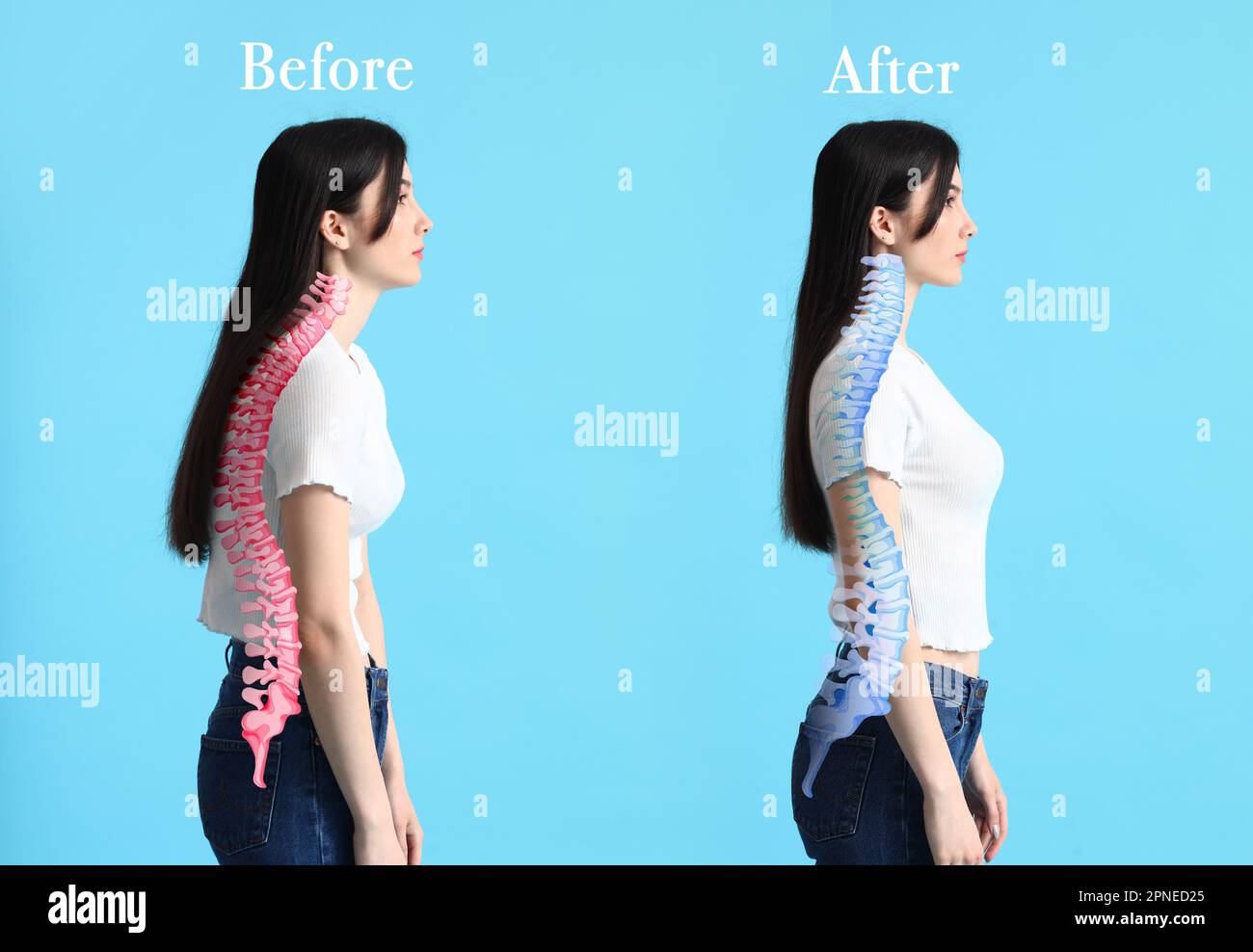 Young woman with bad and proper posture on light blue background Stock ...