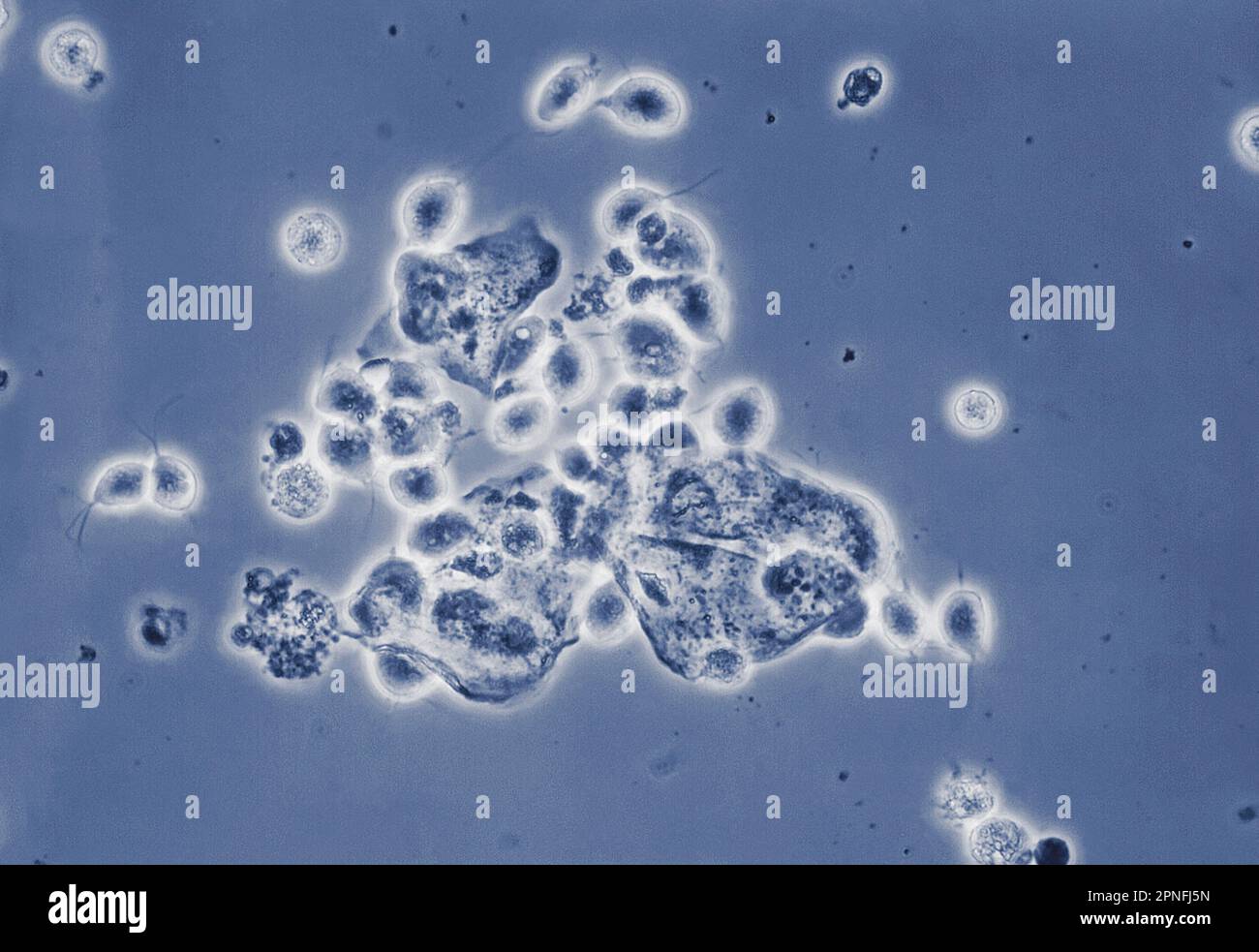 Trichomoniasis, light micrograph Stock Photo - Alamy