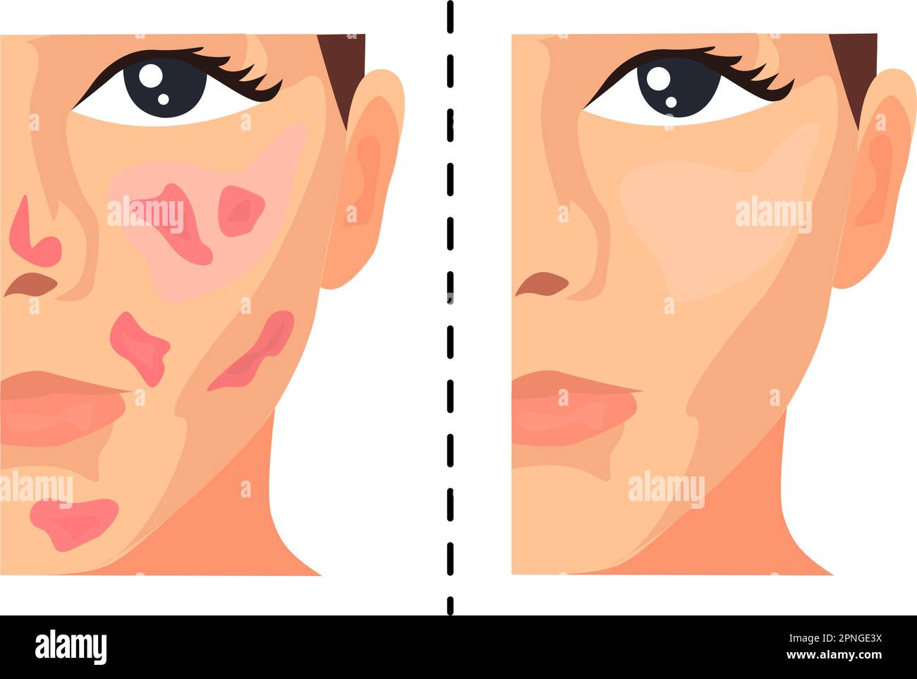 Acne removal illustration in color cartoon style. Editable vector ...