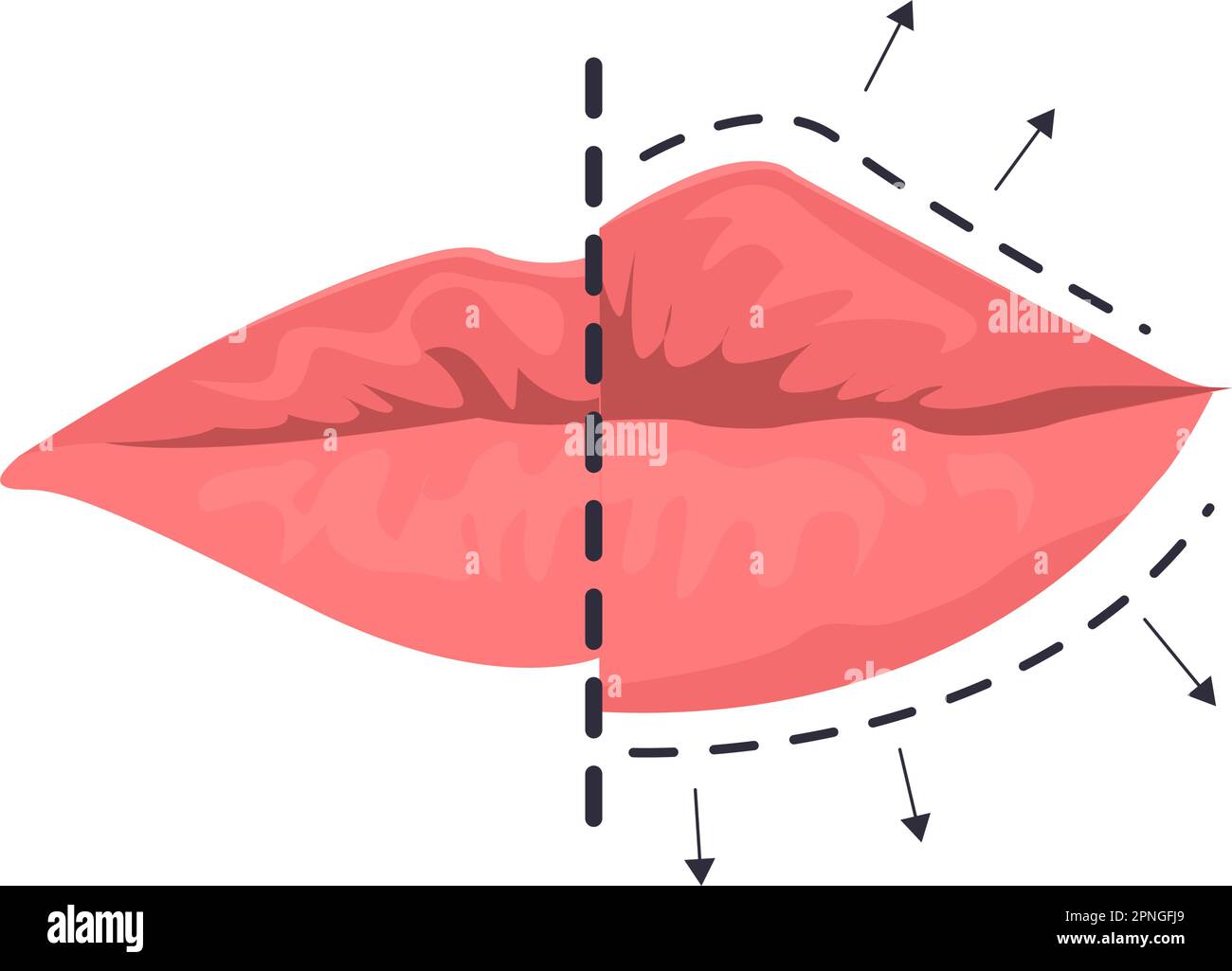 Lip augmentation illustration in color cartoon style. Editable vector ...