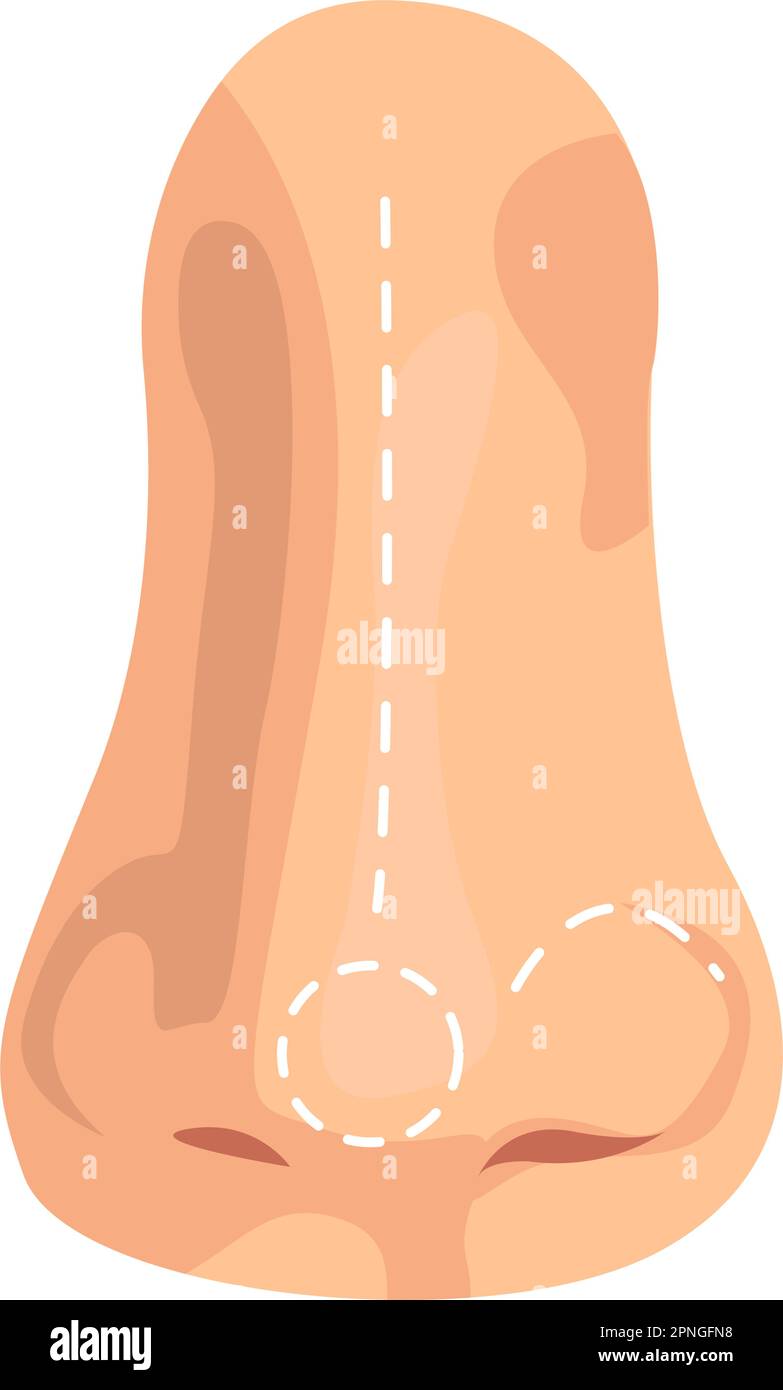 Rhinoplasty illustration in color cartoon style. Editable vector ...