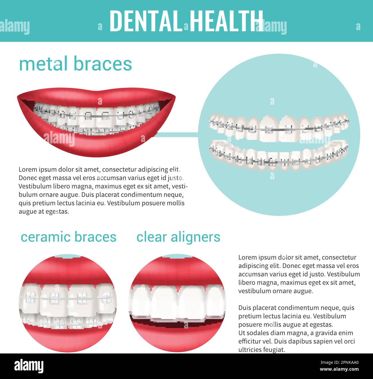 Dental health infographics set with metal and ceramic braces realistic ...