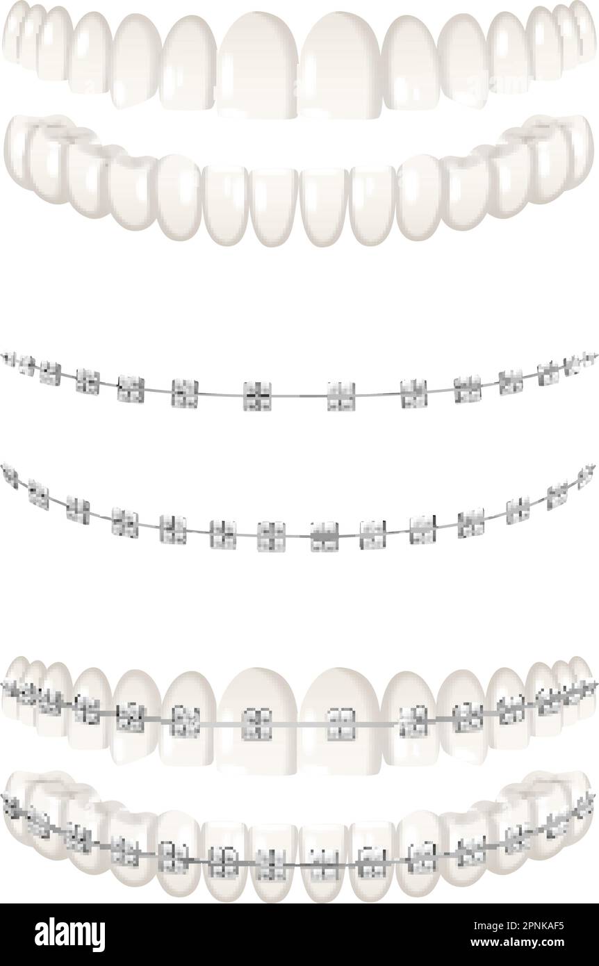 Teeth dental braces realistic icons set isolated vector illustration ...
