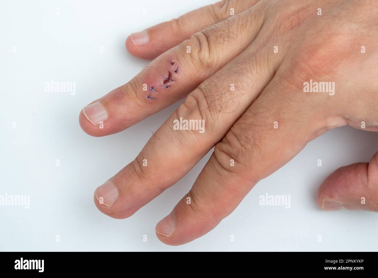 Stitched wound on a finger. Hand with stitched cut wound Stock Photo ...