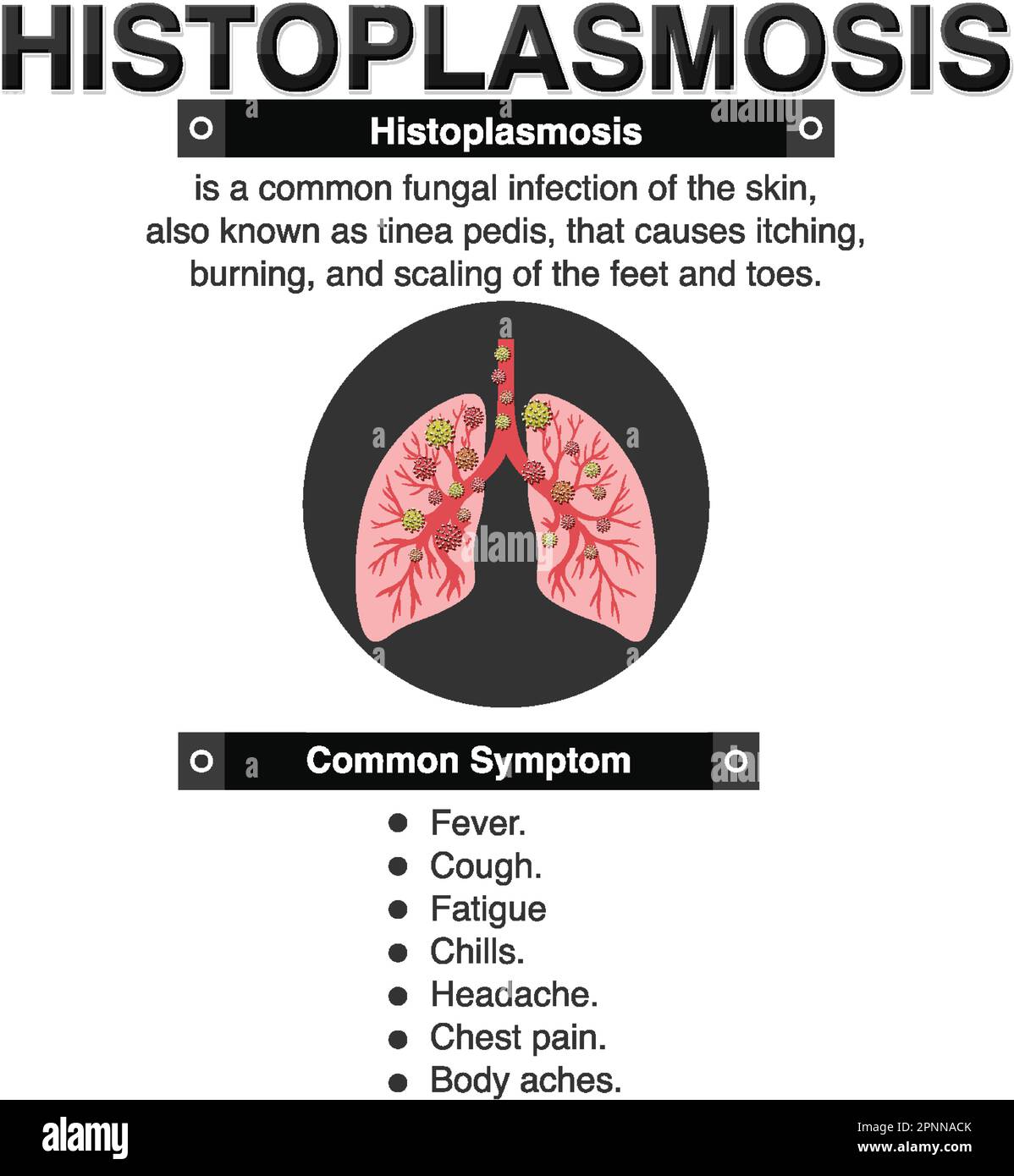 Informative poster of Histoplasmosis illustration Stock Vector Image ...