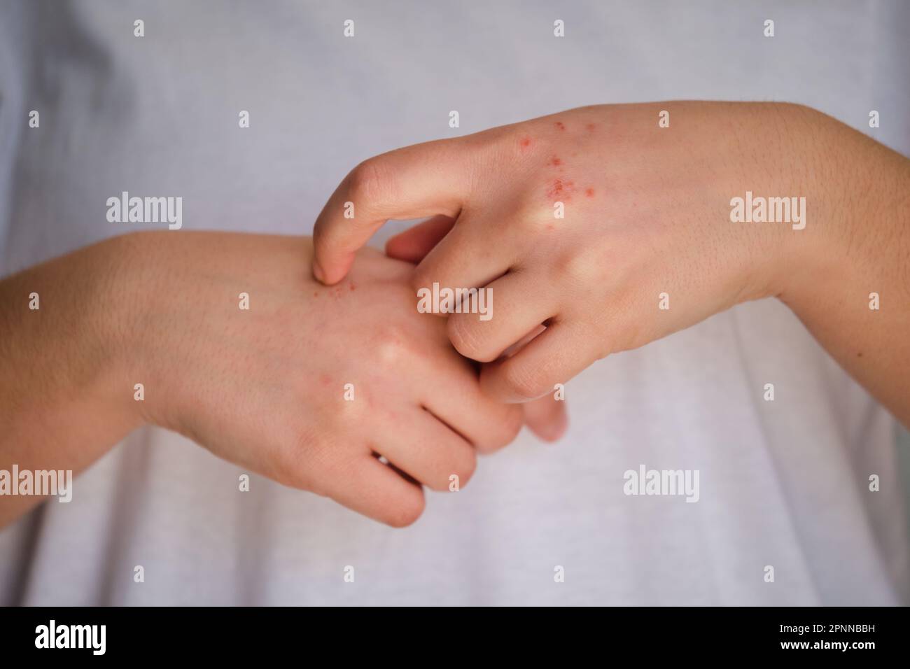 Woman scratching itchy eczema on her hand Stock Photo - Alamy