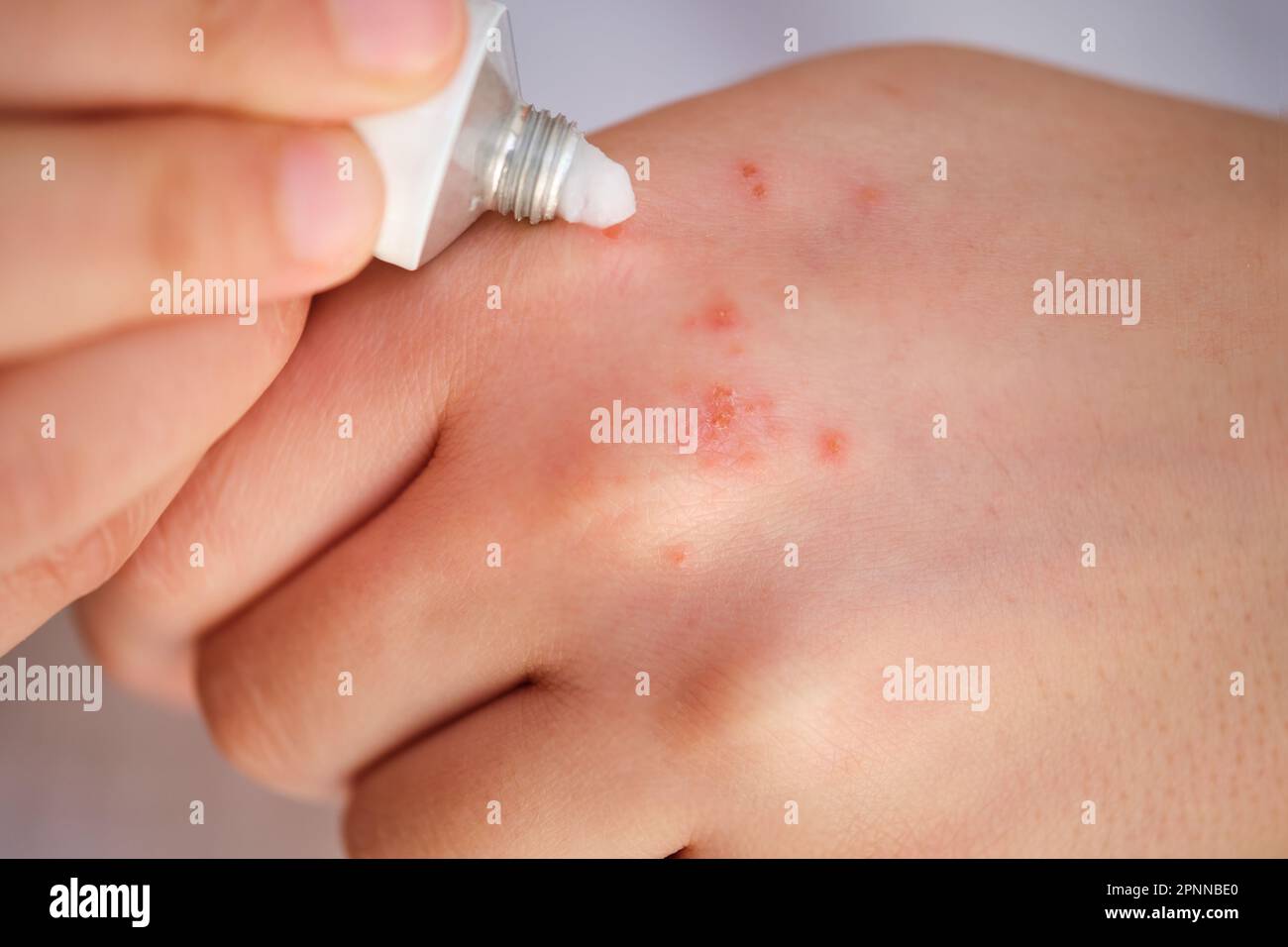 Woman applying white medical corticosteroid ointment on eczema on her ...