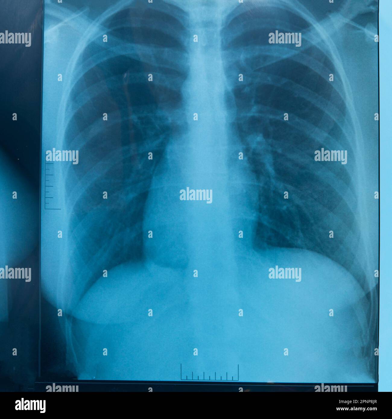Human lung x-ray analysis, doctor examines lung disease. Pneumonia ... Human lung x-ray analysis, doctor examines lung disease. Pneumonia ...
