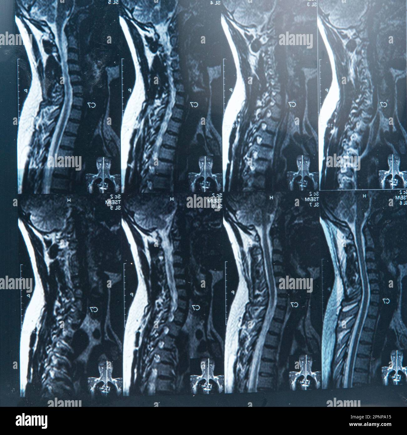 Mri scan lumbar spines hi-res stock photography and images - Alamy