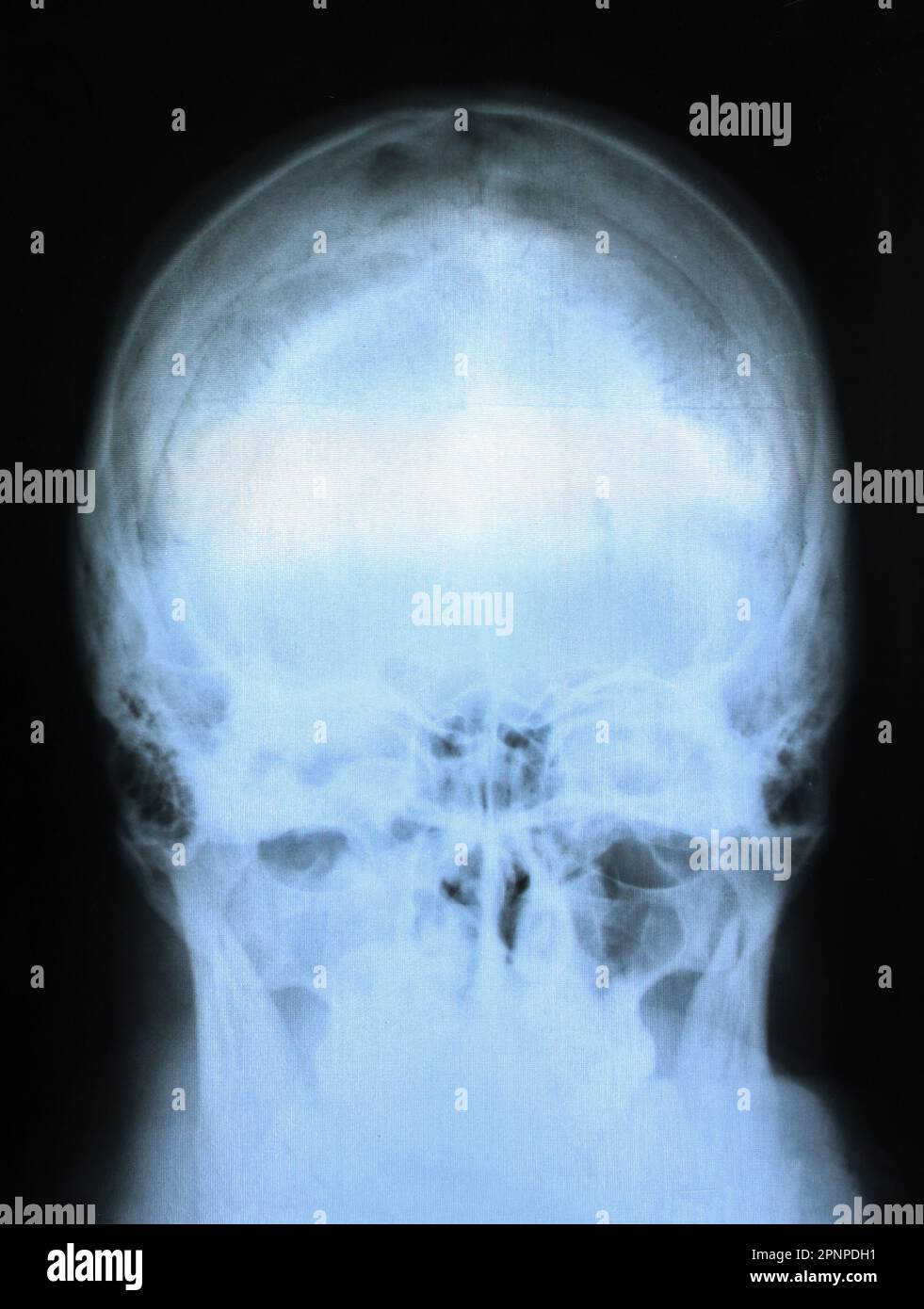 X-ray image of the skull from the back. X-ray of a man's head. Medical ...