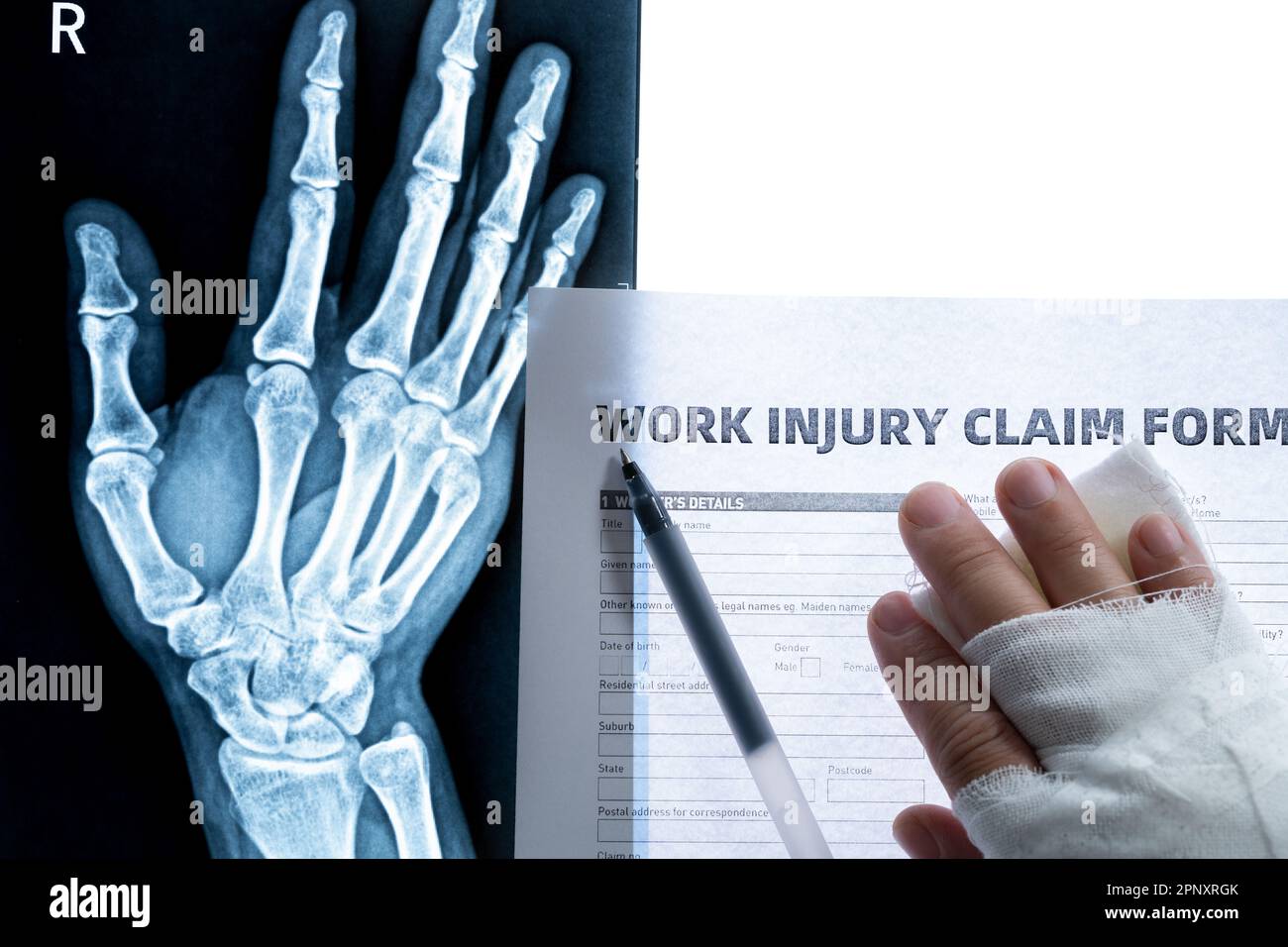 top view X-ray film and a man with wrapped hand on a work injury claim ...