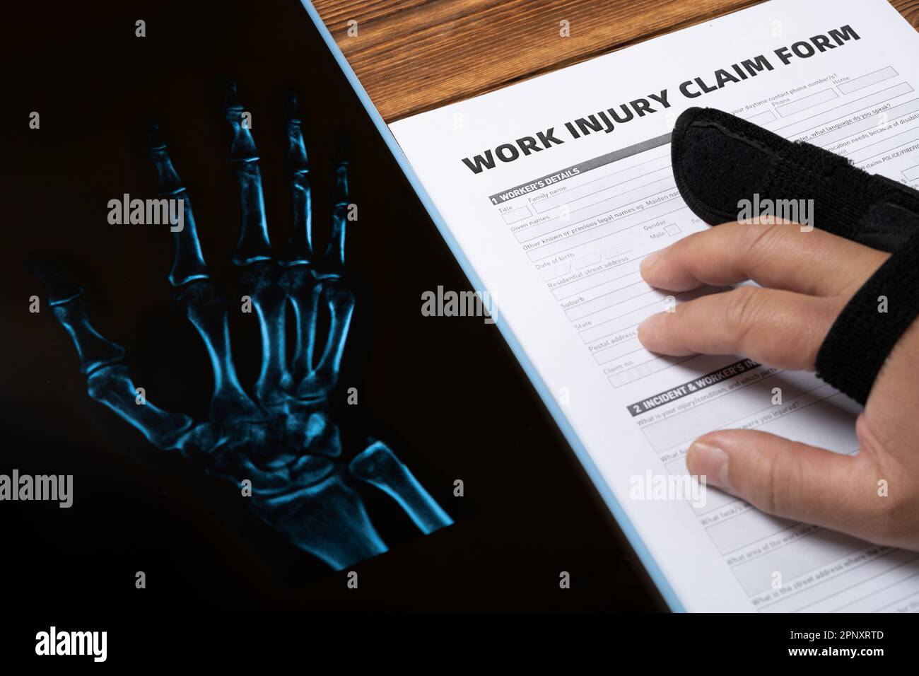 X-ray film and a man with wrapped hand on a work injury claim form ...