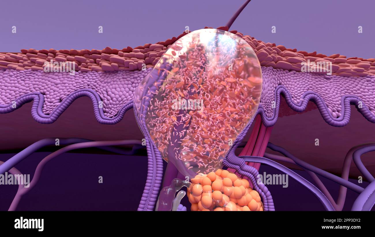 Acnes bacteria hi-res stock photography and images - Alamy