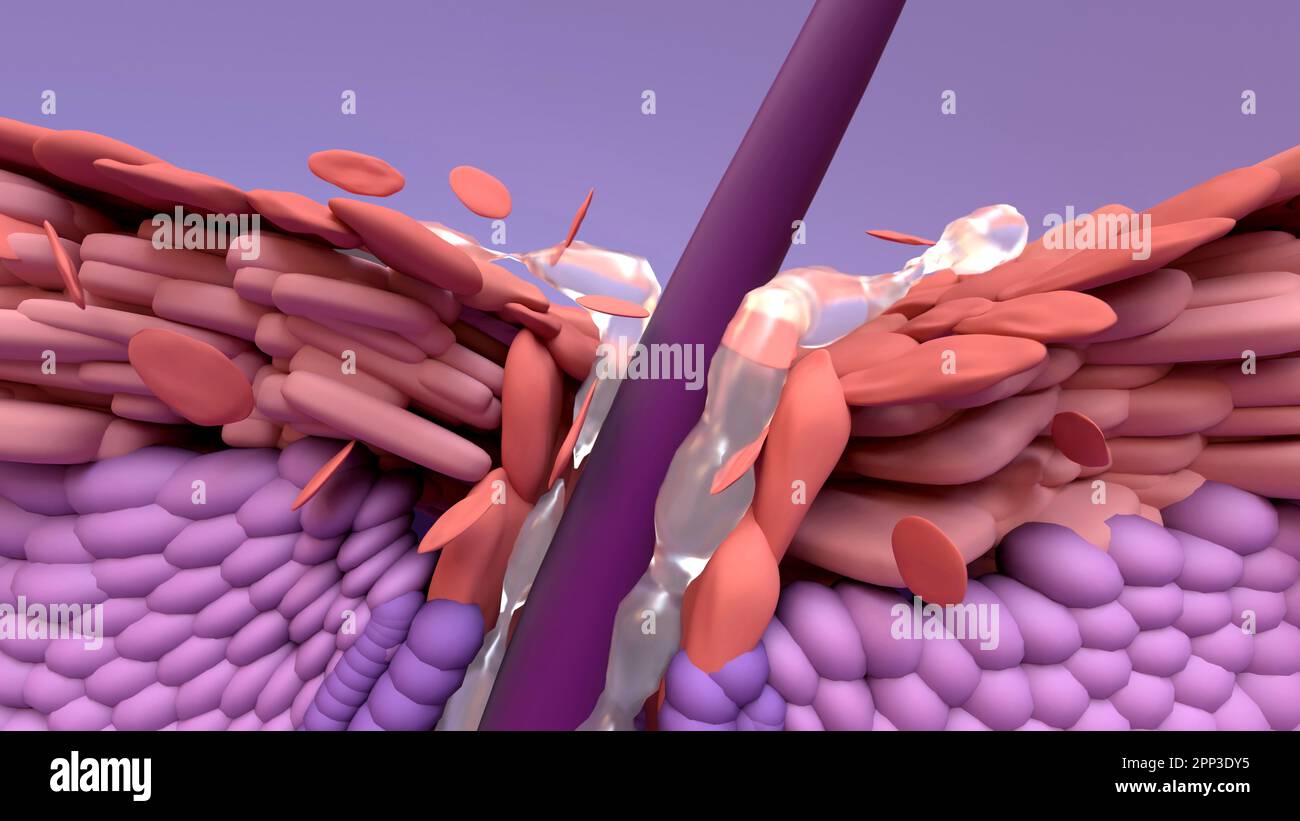 Blocked pore, illustration Stock Photo - Alamy