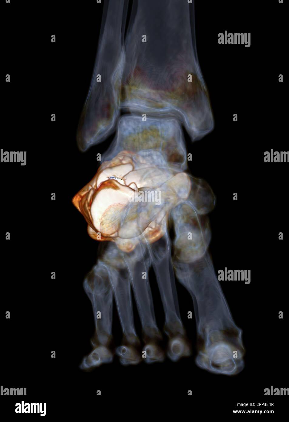 Ct Scan Ankle Joint With 3d Rendering Of Calcaneus Bone Showing Calcaneus Heel Bone Fractures
