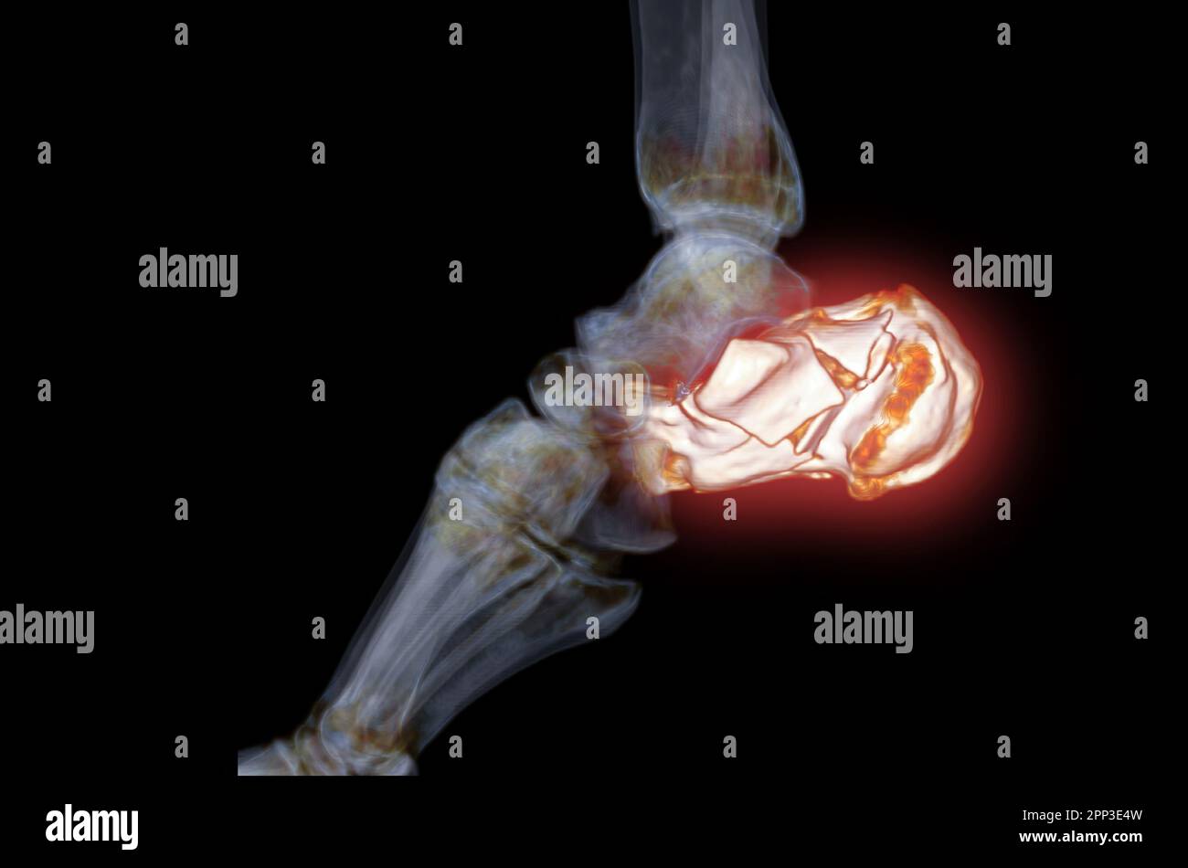 Ct Scan Ankle Joint With 3d Rendering Of Calcaneus Bone Showing Calcaneus Heel Bone Fractures