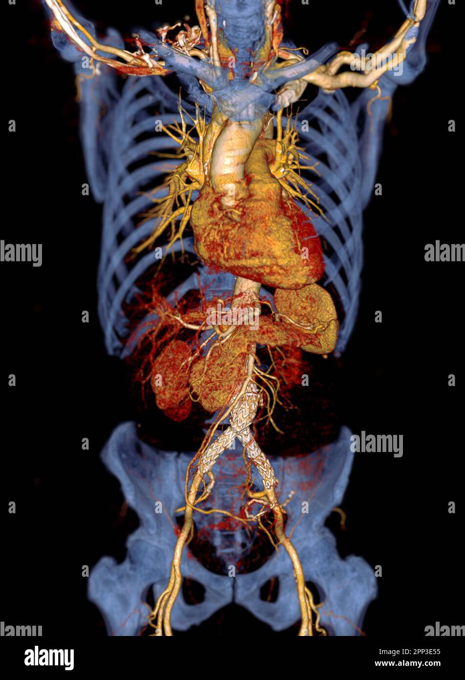 CTA of the aorta with stent-grafting in patient Abdominal aortic ...