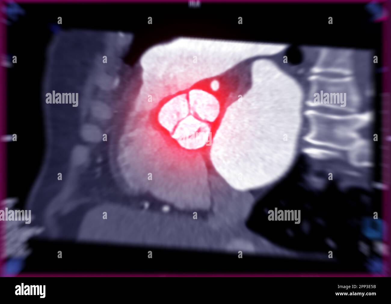 CTA of the aorta showing aortic valve Stock Photo - Alamy