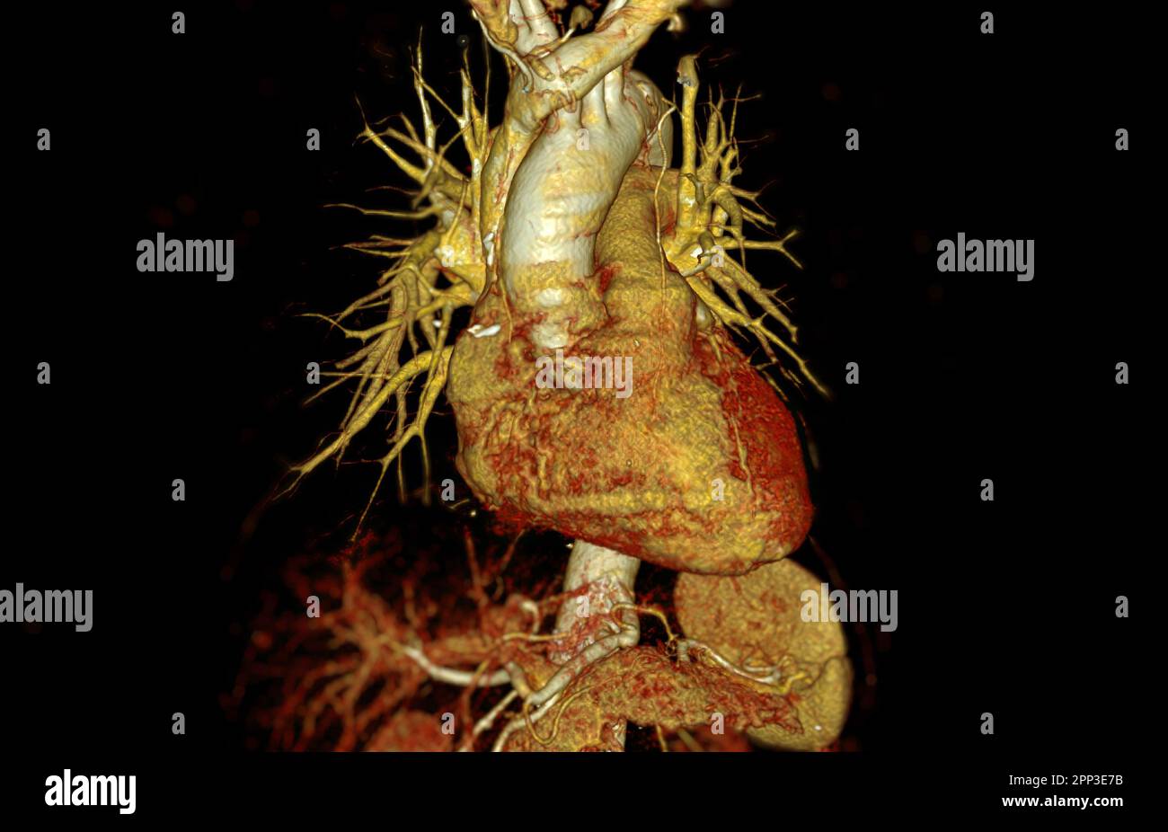 CTA of the aorta with stent-grafting in patient Abdominal aortic ...