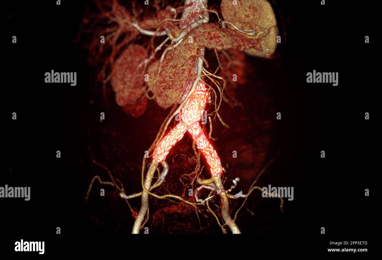 CTA of the aorta with stent-grafting in patient Abdominal aortic ...