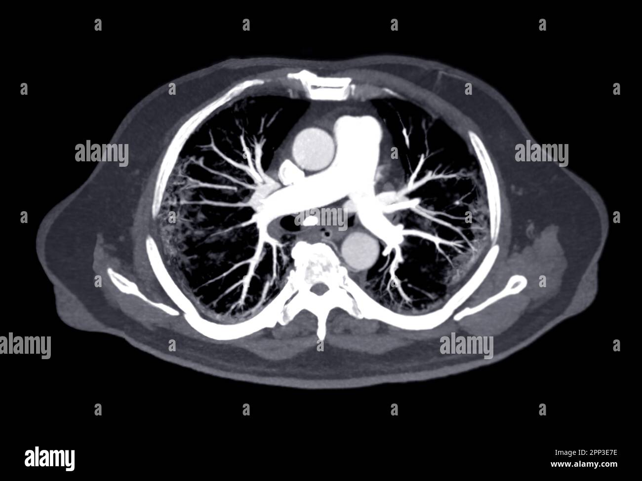 CTA pulmonary arteries 3D rendering showing branch of pulmonary artery ...