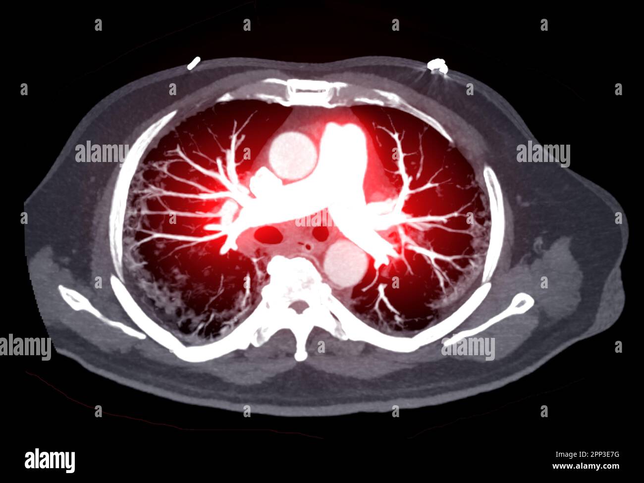 CTA pulmonary arteries 3D rendering showing branch of pulmonary artery ...