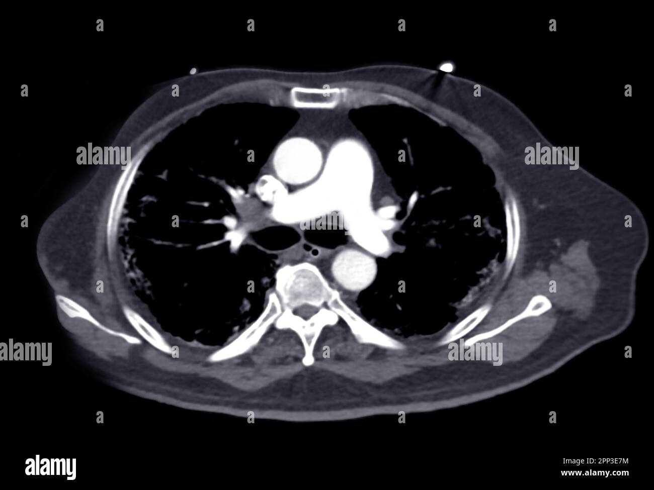 CTA pulmonary arteries 3D rendering showing branch of pulmonary artery ...