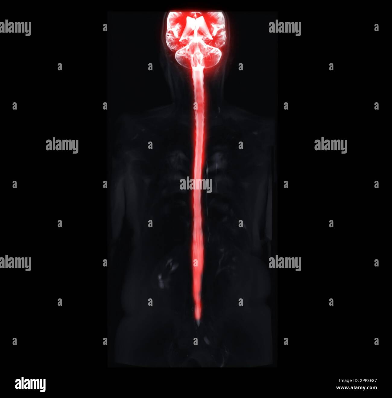 MRI of whole spine showing spinal cord Stock Photo - Alamy