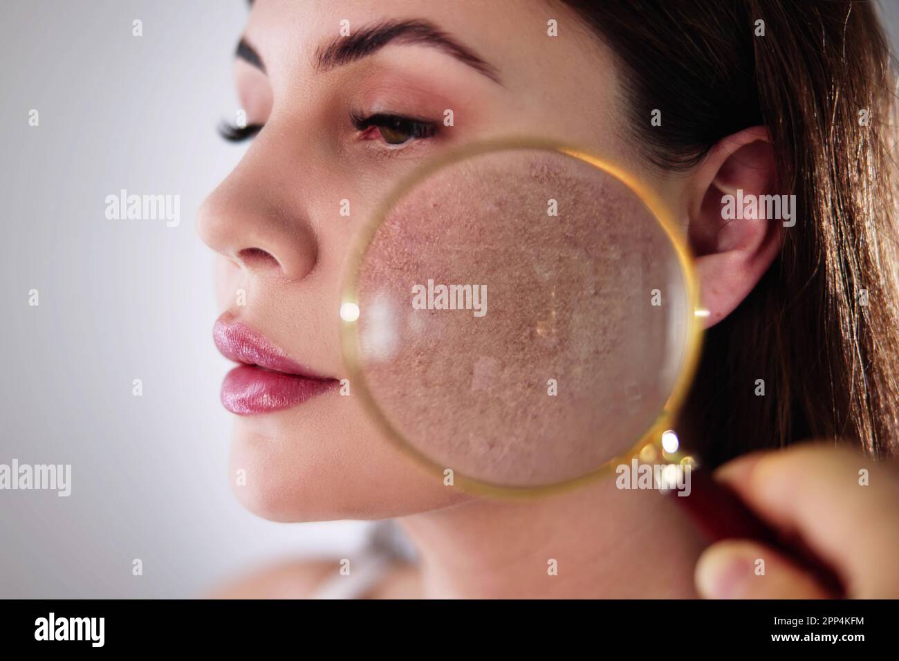 Rosacea Face Skin Problem And Aesthetic Treatment Stock Photo - Alamy