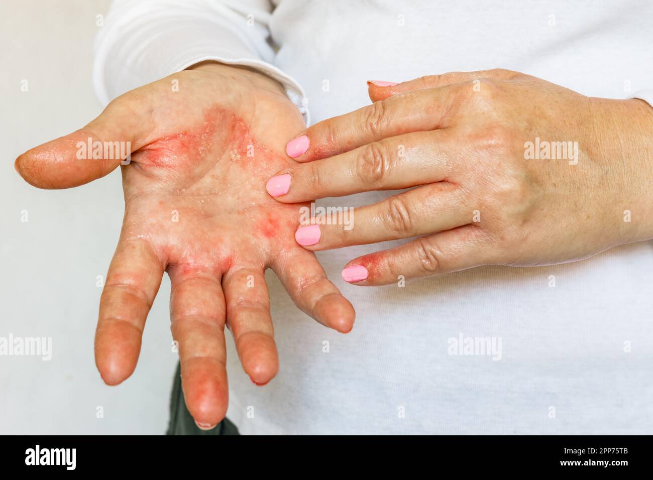 Skin disease, rash, The woman is scratching her itchy hands Stock Photo ...