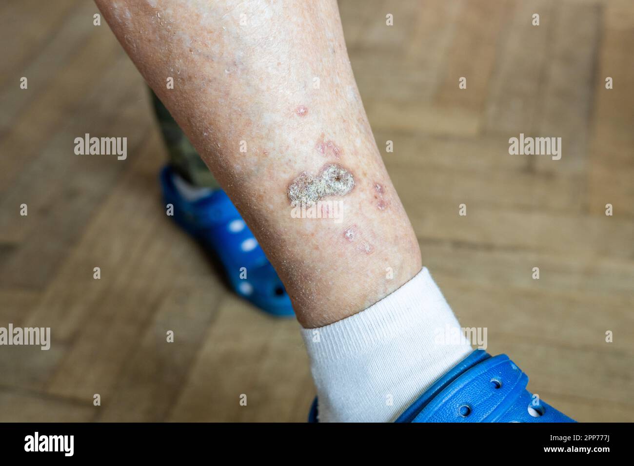 Decubitus treatment hi-res stock photography and images - Alamy