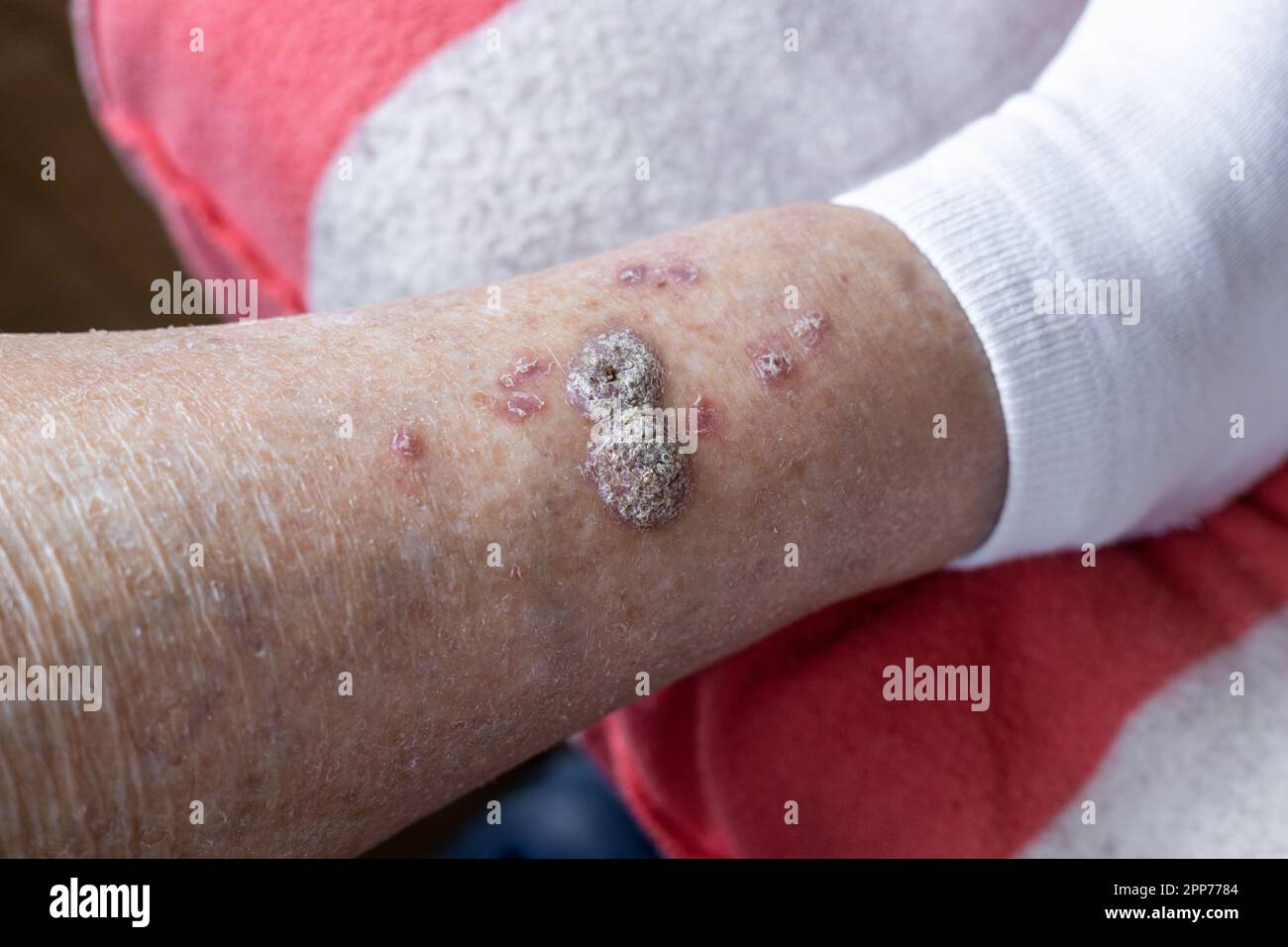 Ulcers and skin diseases, dried scabs and fresh wounds on the legs of ...