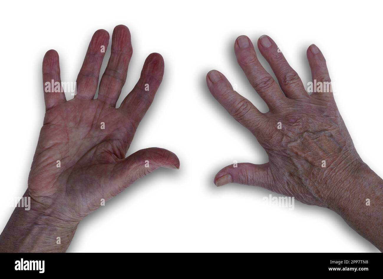 Palm and back of the hands of an elderly woman with osteoarthritis ...