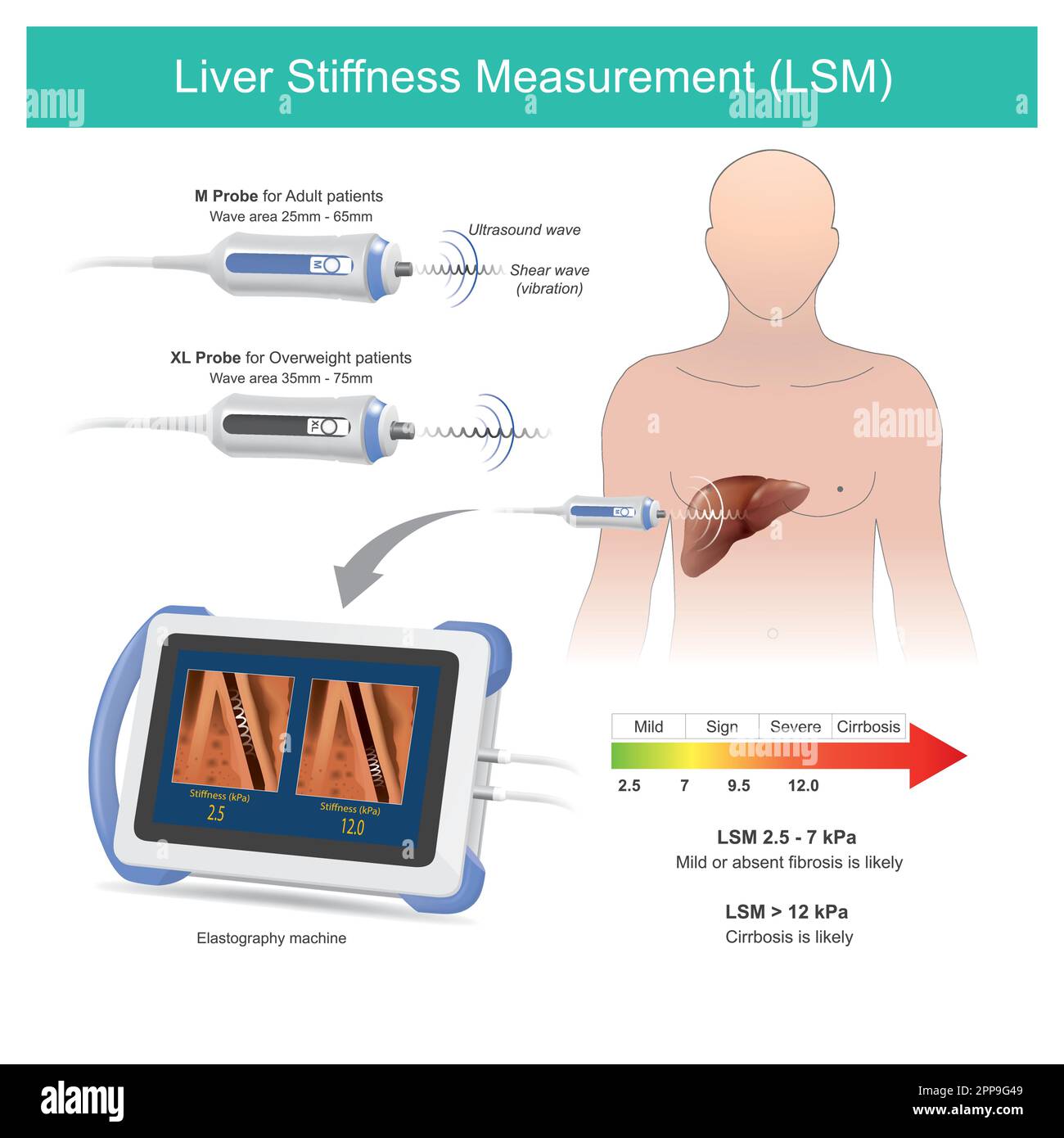 Liver Stiffness Measurement. Measuring tissue liver stiffness in ...