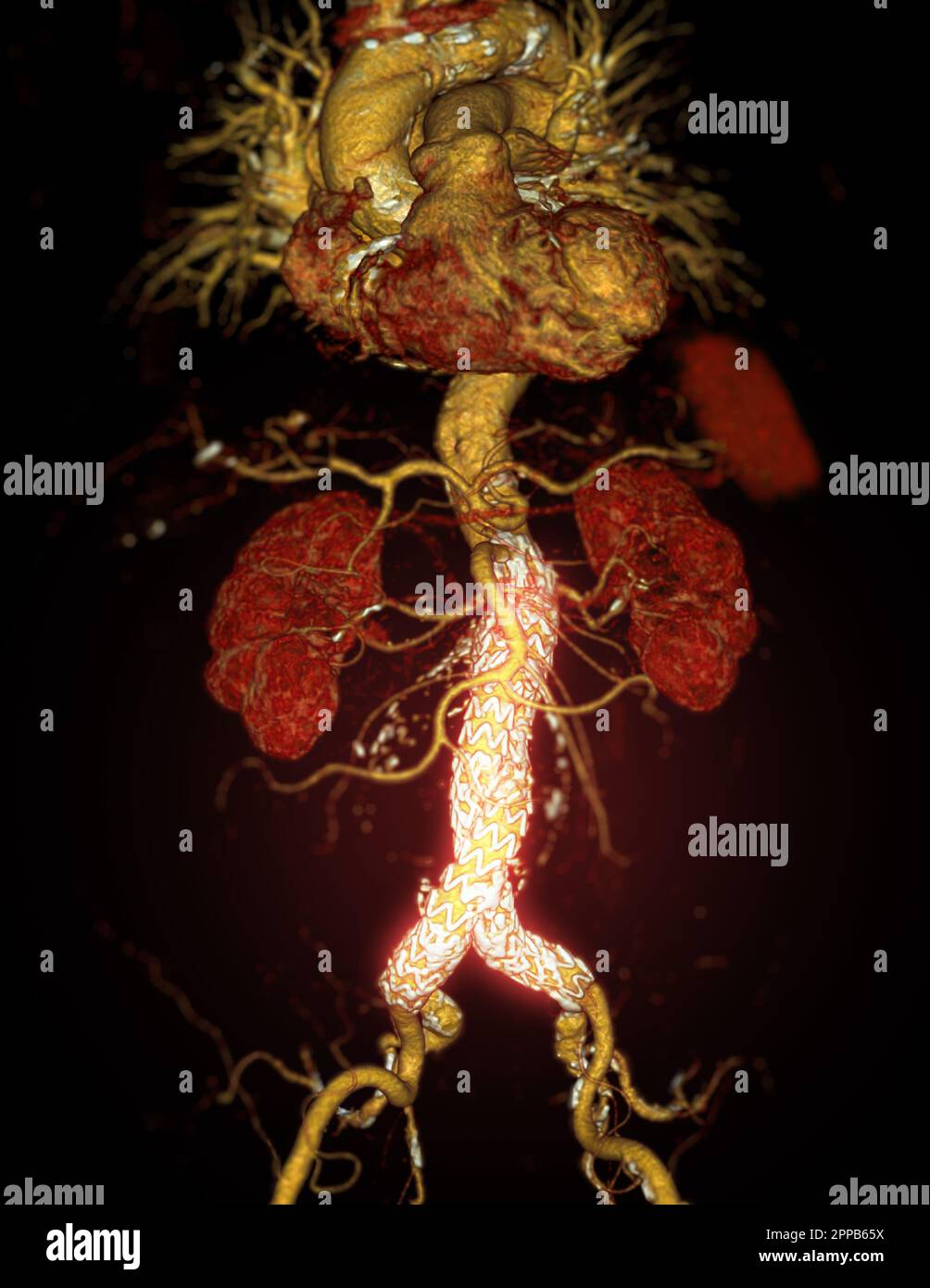 CTA whole aorta with Abdominal aorta stent graft 3D rendering image in ...