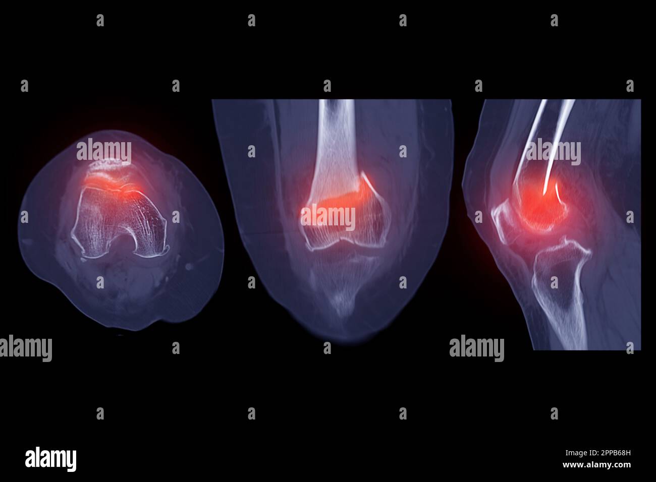 CT scan of knee joint 3D rendering image showing fracture of distal ...