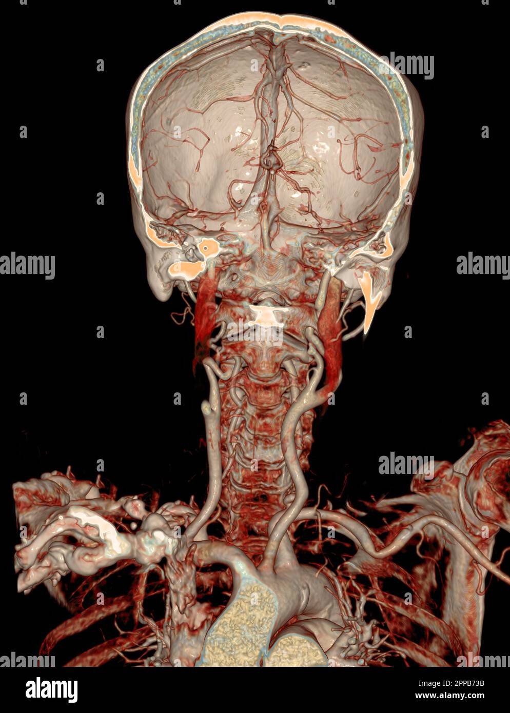 CTA brain and carotid artery or CT angiography of the brain 3D ...