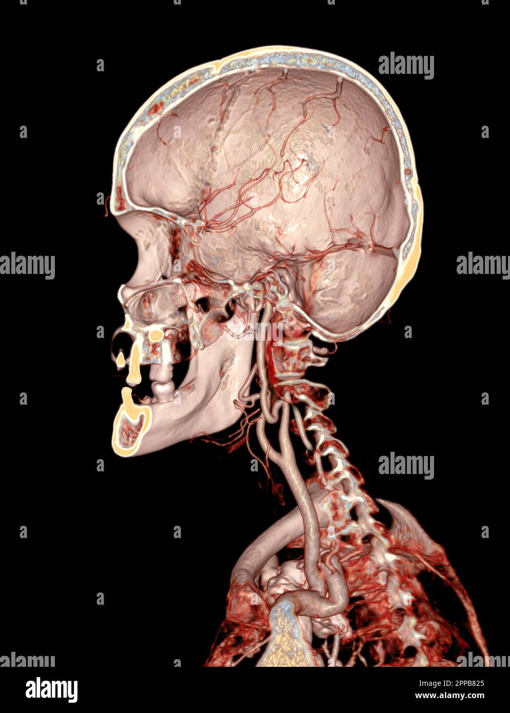 Cta Brain And Carotid Artery Or Ct Angiography Of The Brain 3d