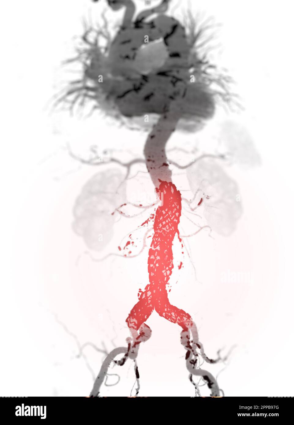 CTA whole aorta with Abdominal aorta stent graft 3D rendering image in ...