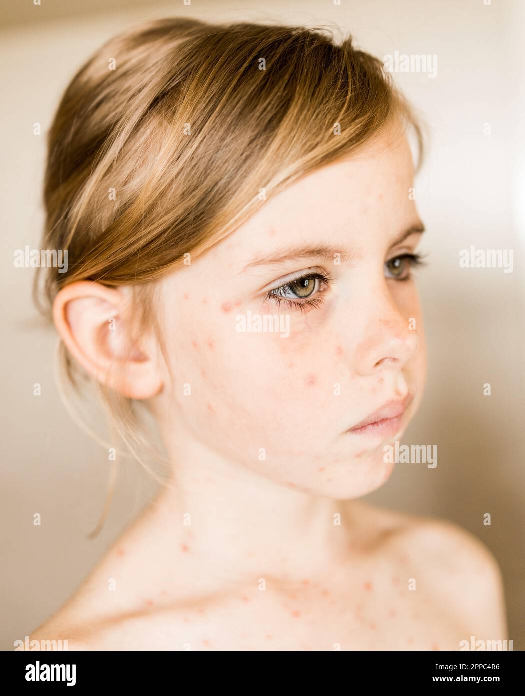 Chickenpox, varicella virus or vesicular rash on little girl body and ...