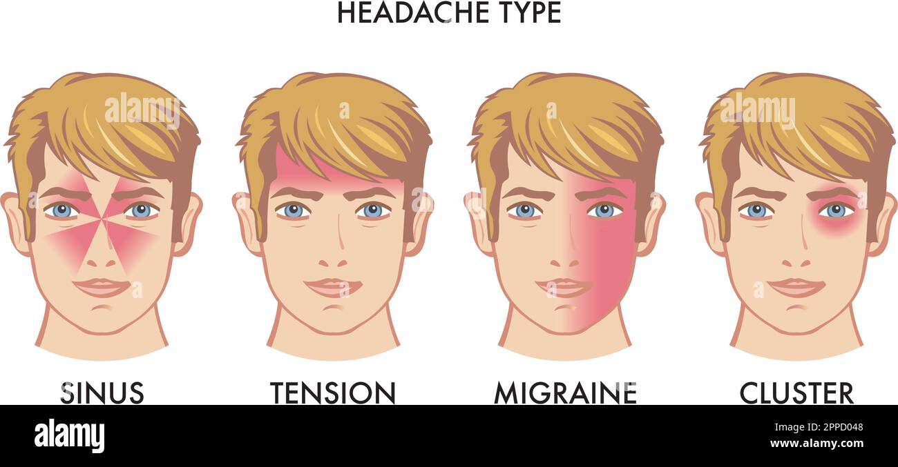 Illustration of types of headache Stock Vector Image & Art - Alamy