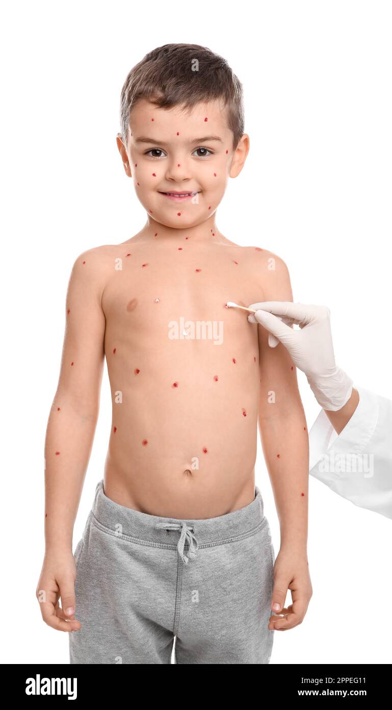 Doctor applying cream onto skin of little boy with chickenpox on white ...
