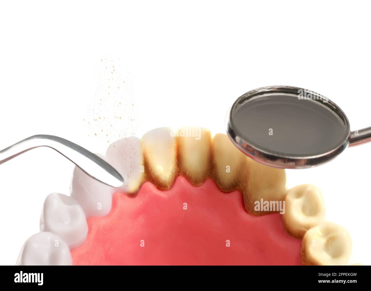 Calculus teeth hi-res stock photography and images - Alamy