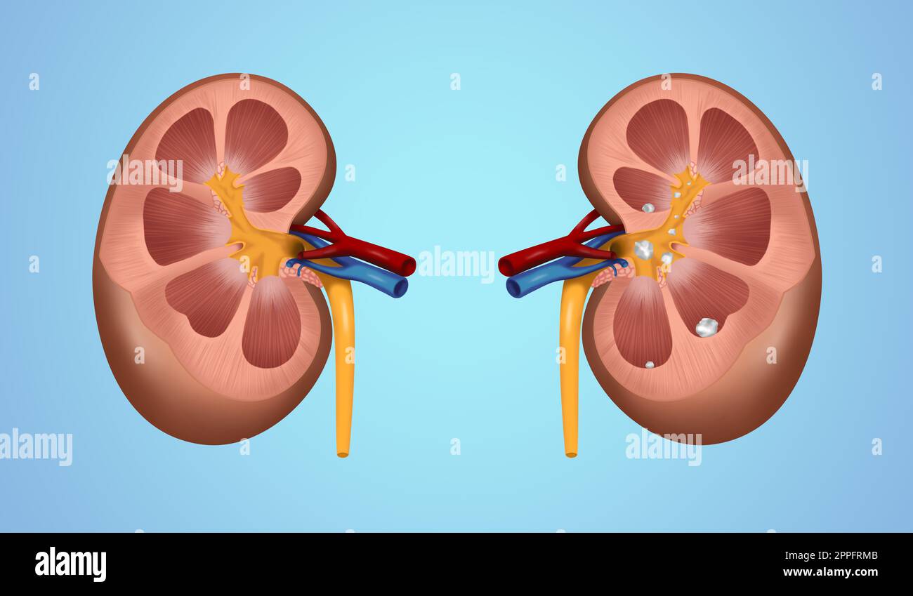 Illustration of human kidney stones on blue background. Banner design ...