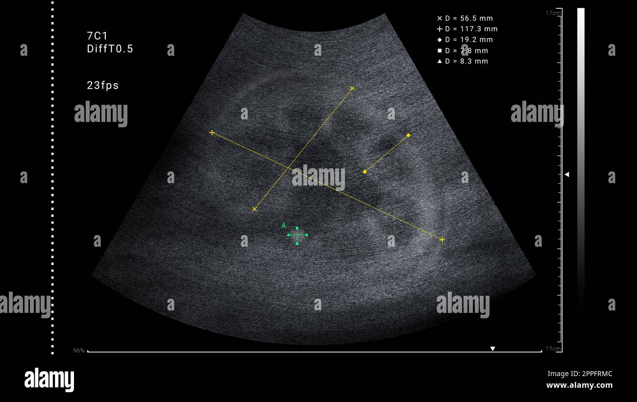 Sonogram of human kidney, illustration. Ultrasound diagnostic Stock ...