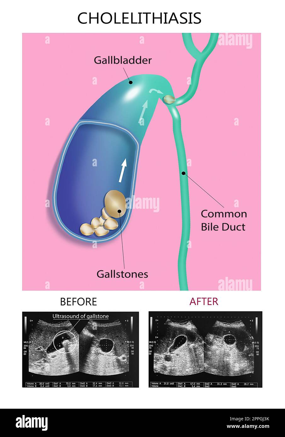 Gallstones hi-res stock photography and images - Alamy