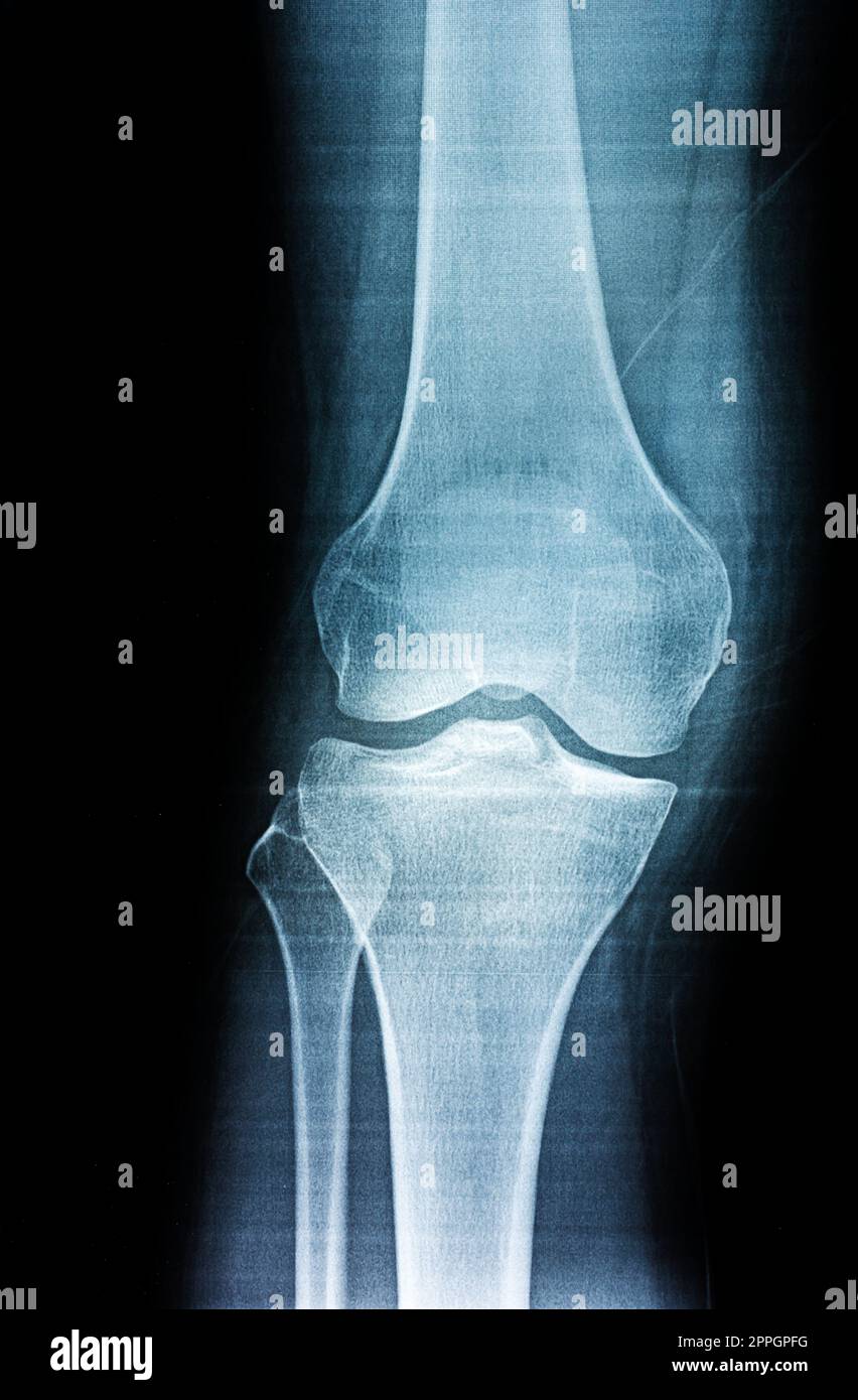 Tibia x ray hi-res stock photography and images - Alamy