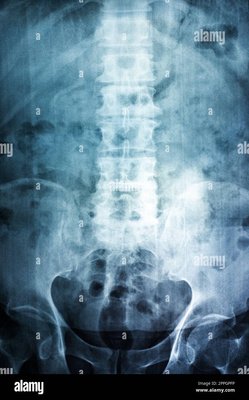X ray spine hi-res stock photography and images - Alamy